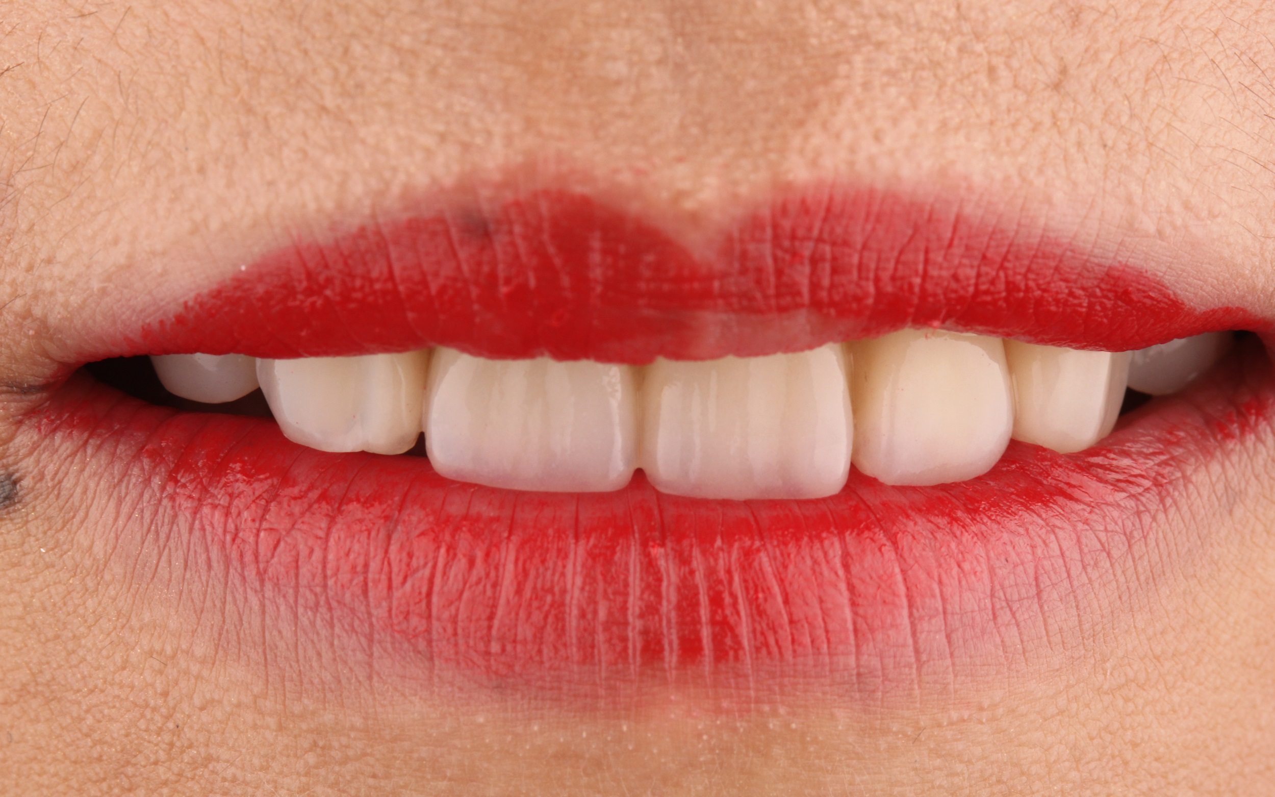 微微一改就很美——牙列缺损的二次美学修复|赵鹏&洪昱全-成都贝施美生物科技有限公司